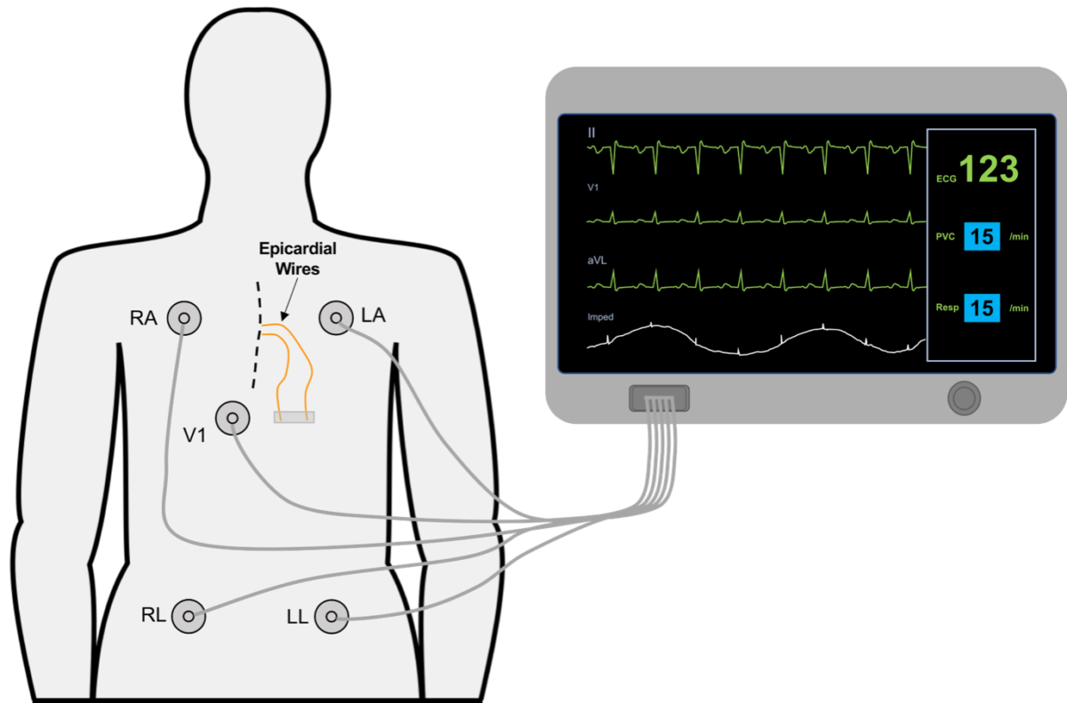 Display of the Surface and Atrial Electrogram – Atrial Electrogram ...