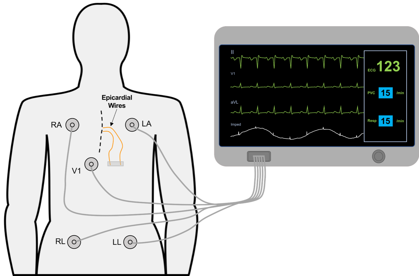 Display of the Surface and Atrial Electrogram – Atrial Electrogram Education – UW–Madison