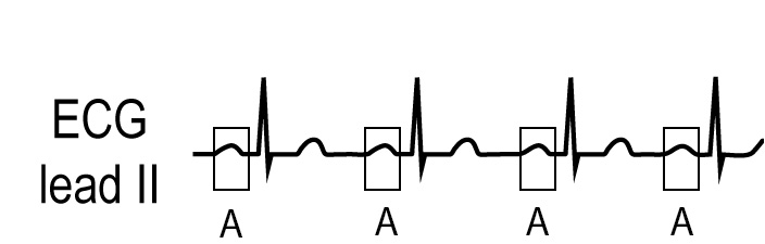 Display of the Surface and Atrial Electrogram – Atrial Electrogram ...