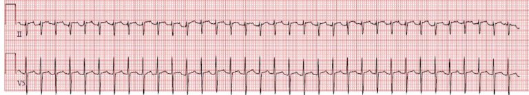 Display of the Surface and Atrial Electrogram – Atrial Electrogram ...