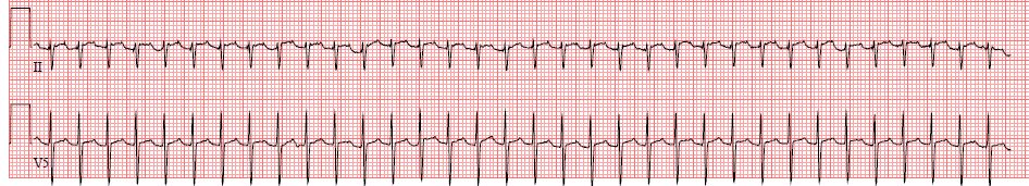 Display of the Surface and Atrial Electrogram – Atrial Electrogram ...