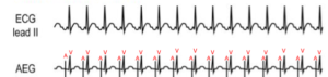 Identifying the Atrial Signals – Atrial Electrogram Education – UW–Madison