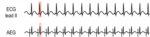 Identifying the Atrial Signals – Atrial Electrogram Education – UW–Madison