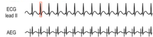 Identifying the Atrial Signals – Atrial Electrogram Education – UW–Madison