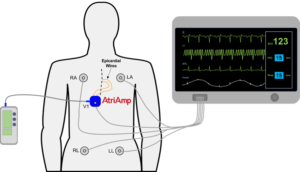 Identifying the Atrial Signals – Atrial Electrogram Education – UW–Madison