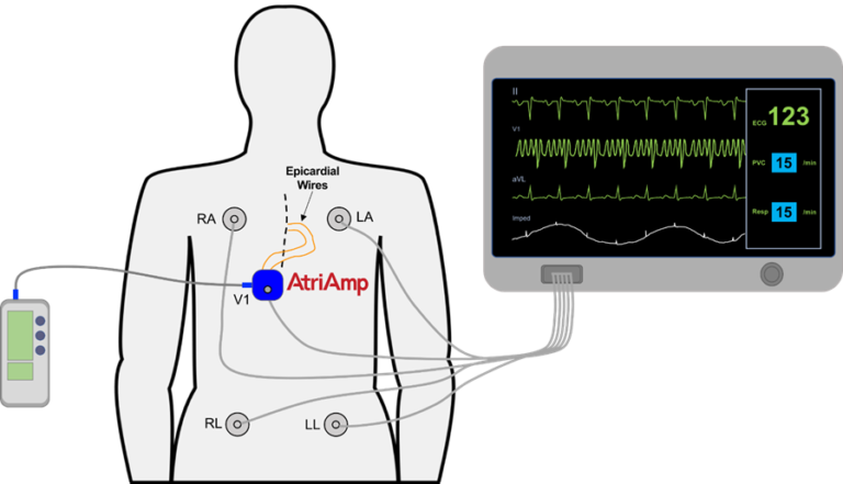 Identifying the Atrial Signals – Atrial Electrogram Education – UW–Madison
