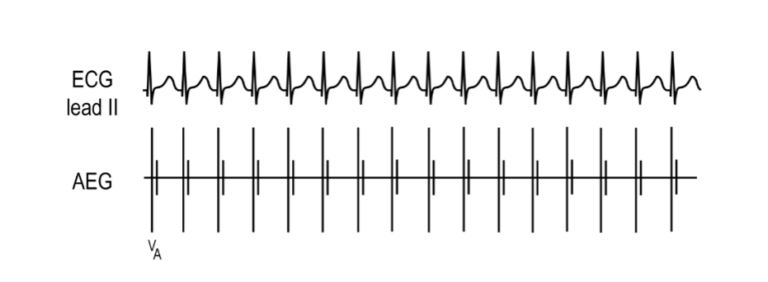 Atrioventricular Nodal Reentrant Tachycardia (AVNRT) – Atrial ...