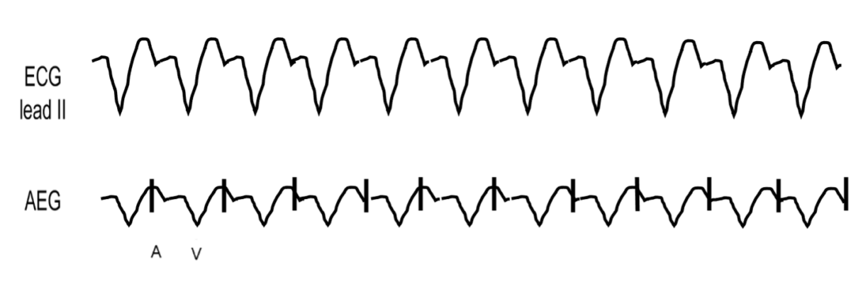 Accelerated Ventricular Rhythm – Atrial Electrogram Education – UW–Madison