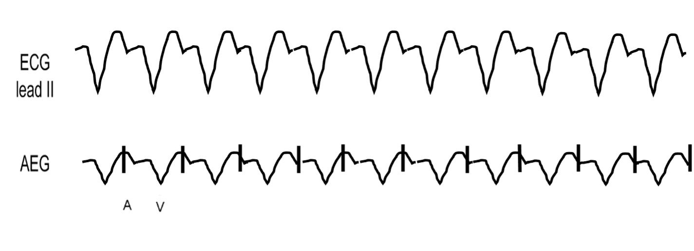 Accelerated Ventricular Rhythm – Atrial Electrogram Education – UW–Madison