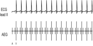 Intra-Atrial Reentrant Tachycardia (IART) – Atrial Electrogram ...