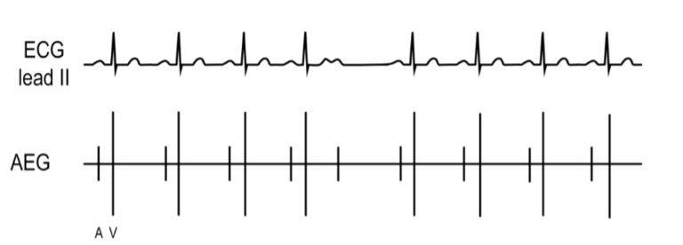 Premature Atrial Complex (PAC) – Atrial Electrogram Education – UW–Madison