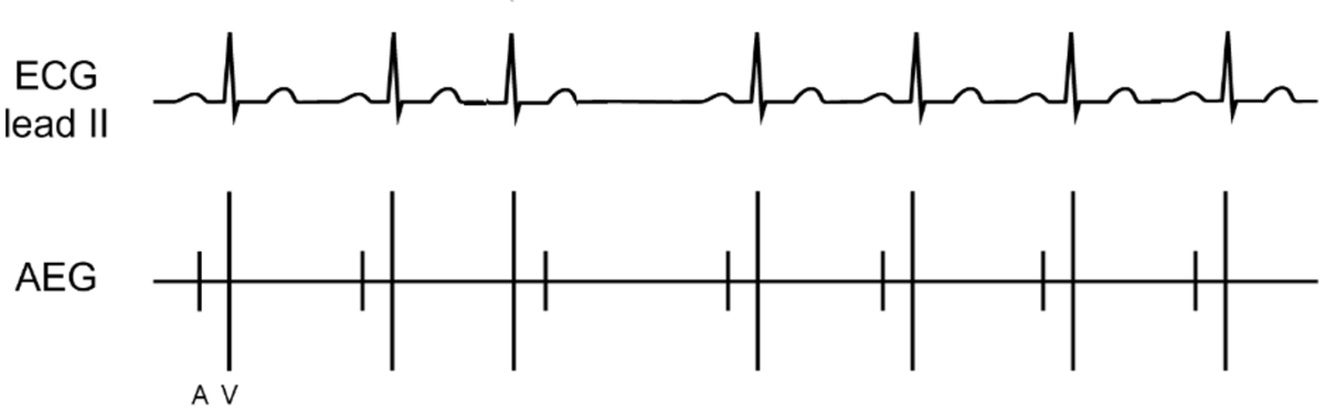 Premature Junctional Complex (PJC) – Atrial Electrogram Education – UW ...