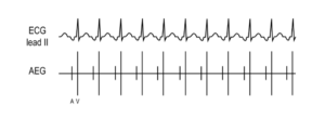 Persistent Junctional Reciprocating Tachycardia (PJRT) – Atrial ...
