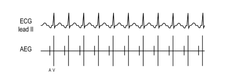 Persistent Junctional Reciprocating Tachycardia (PJRT) – Atrial ...