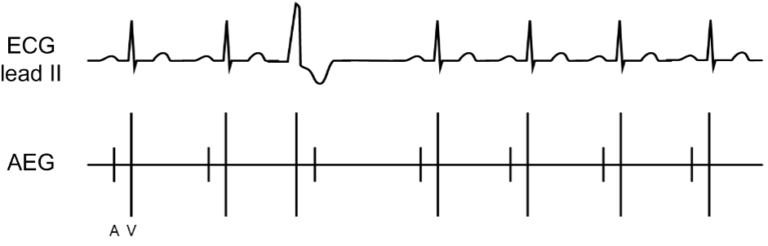 Premature Ventricular Complex (PVC) – Atrial Electrogram Education – UW ...