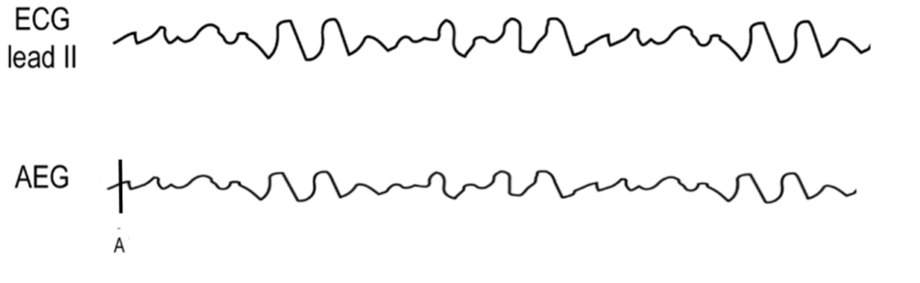 Ventricular Fibrillation (VF) / Torsades de Pointes – Atrial ...