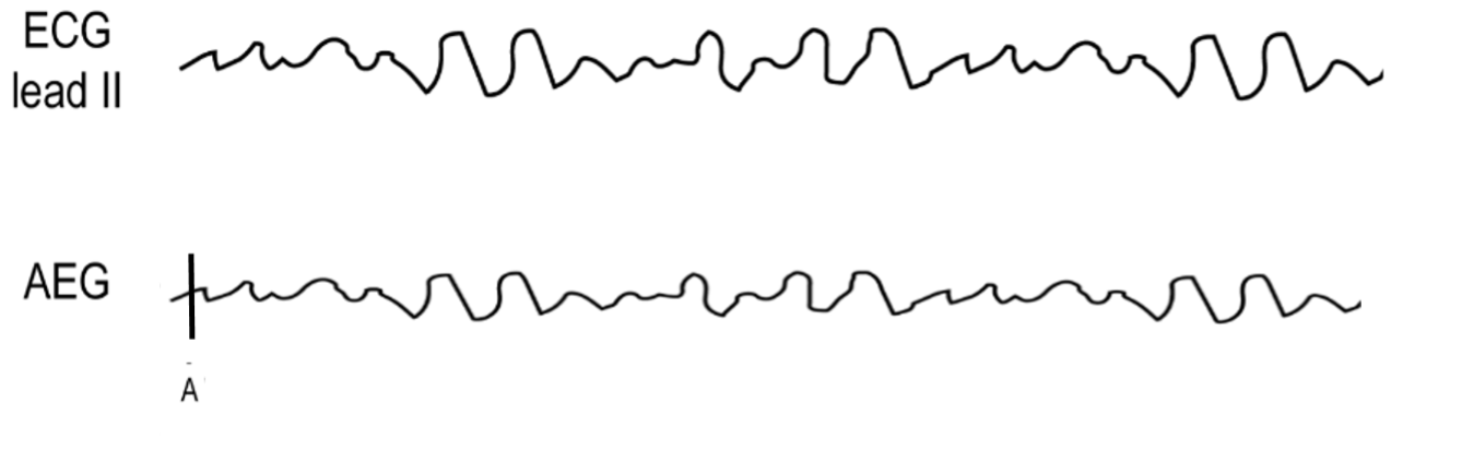 Ventricular Fibrillation (VF) / Torsades de Pointes – Atrial ...
