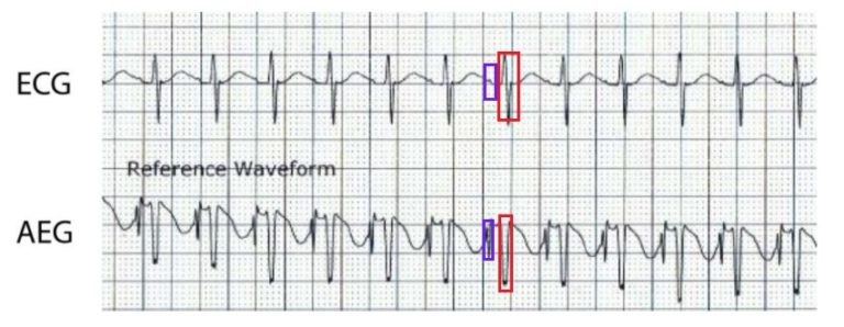 Identifying the Atrial Signals – Atrial Electrogram Education – UW–Madison
