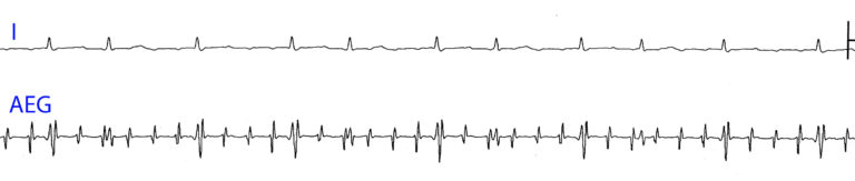 Intra-Atrial Reentrant Tachycardia (IART) – Atrial Electrogram ...