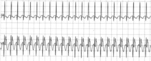 AtrioVentricular Reentrant Tachycardia (AVRT) – Atrial Electrogram ...