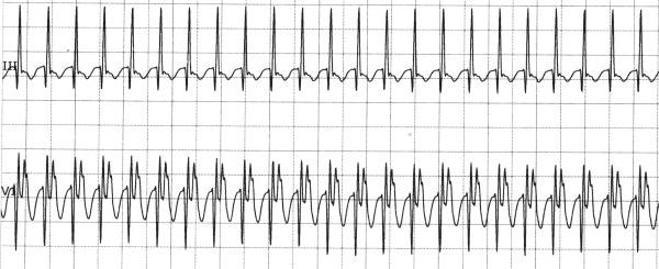 AtrioVentricular Reentrant Tachycardia (AVRT) – Atrial Electrogram ...