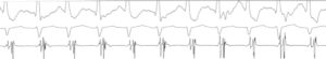 Atrioventricular Nodal Reentrant Tachycardia (AVNRT) – Atrial ...