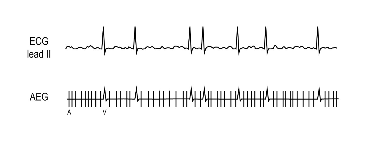 Atrial Fibrillation (AF) – Atrial Electrogram Education – UW–Madison