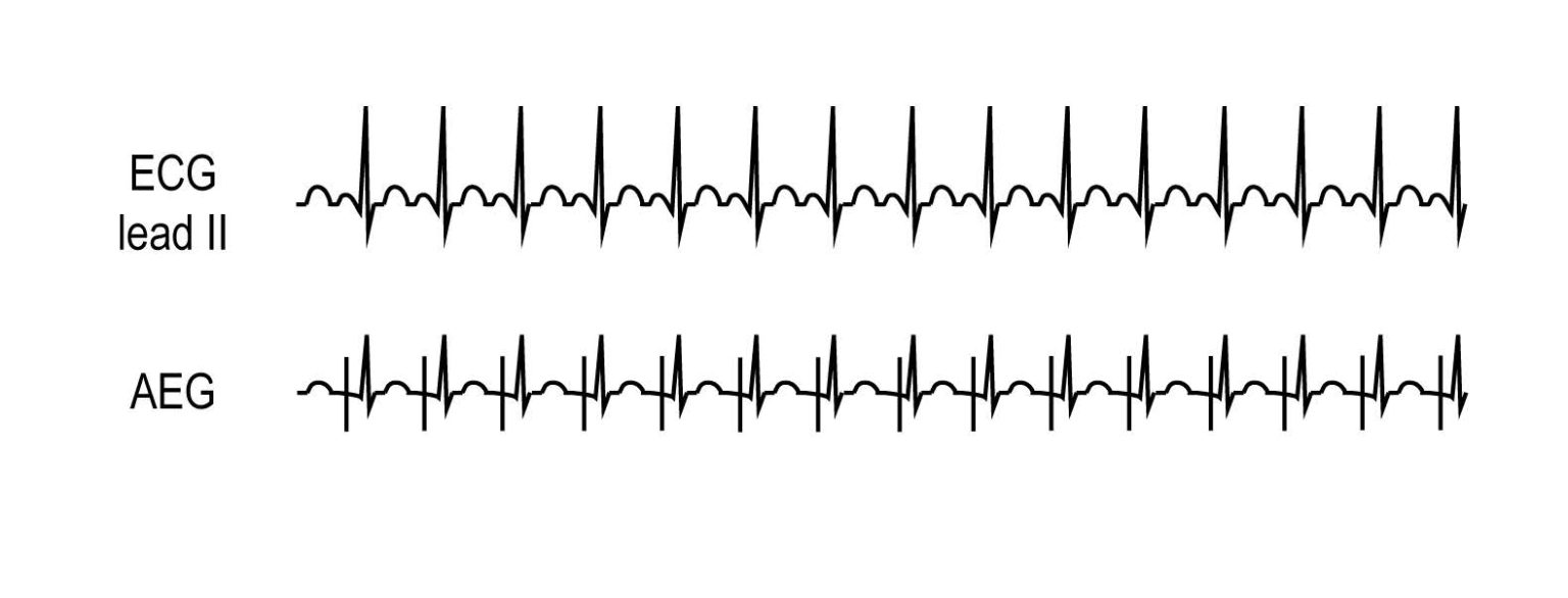 Sinus Tachycardia – Atrial Electrogram Education – UW–Madison