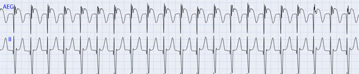 Junctional Ectopic Tachycardia (JET) – Atrial Electrogram Education ...