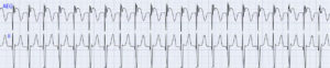 Junctional Ectopic Tachycardia (JET) – Atrial Electrogram Education ...