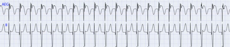 Junctional Ectopic Tachycardia (JET) – Atrial Electrogram Education ...