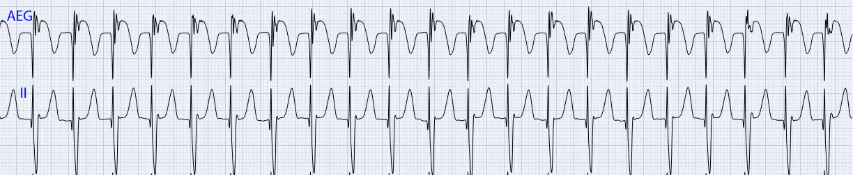 Junctional Ectopic Tachycardia (JET) – Atrial Electrogram Education ...
