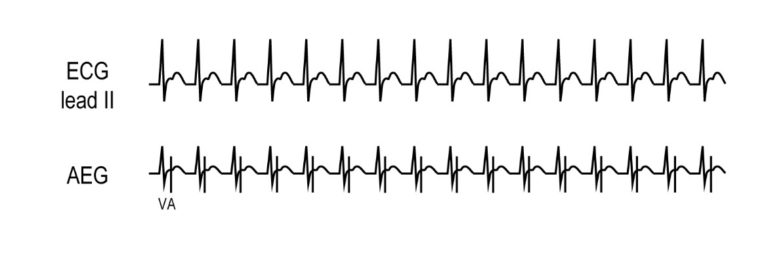 AtrioVentricular Reentrant Tachycardia (AVRT) – Atrial Electrogram ...