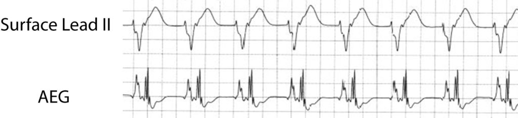 Accelerated Ventricular Rhythm – Atrial Electrogram Education – UW–Madison