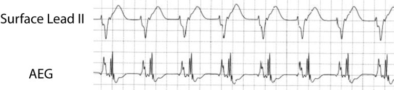 Accelerated Ventricular Rhythm – Atrial Electrogram Education – UW–Madison