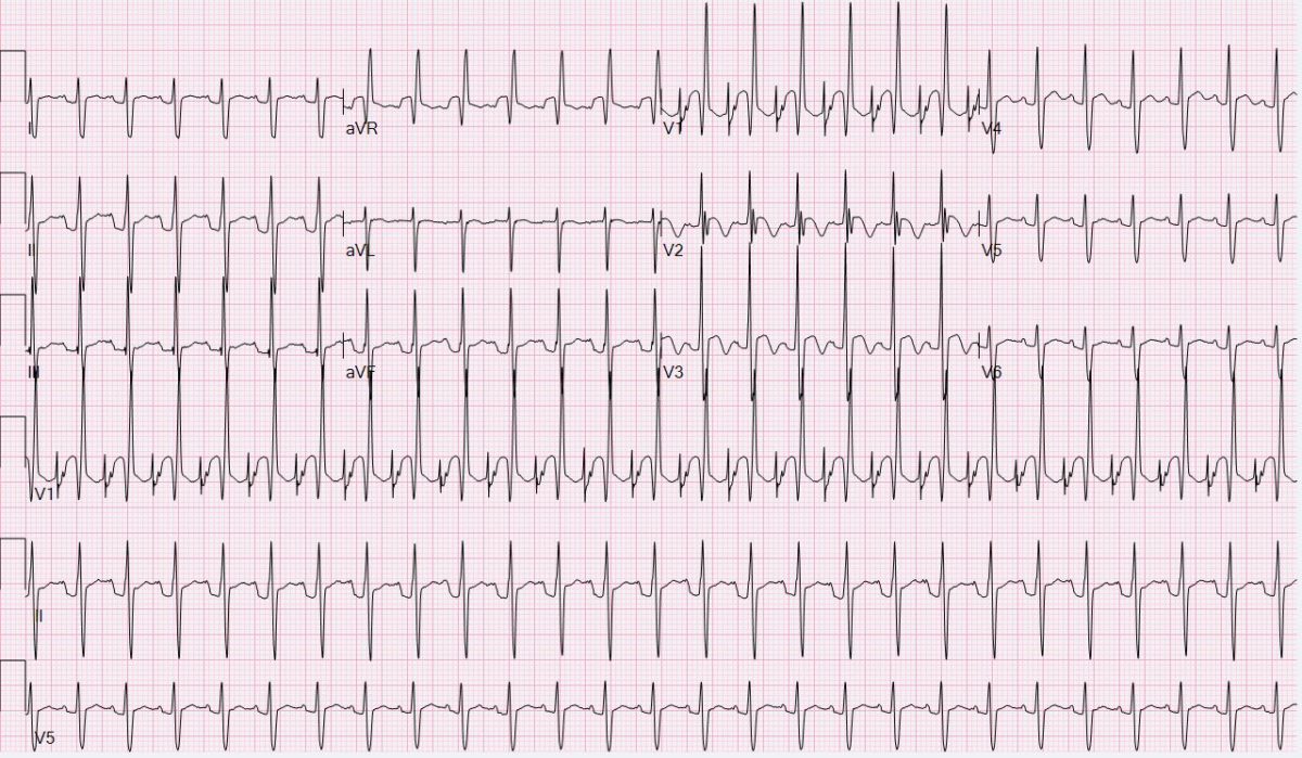 Display of the Surface and Atrial Electrogram – Atrial Electrogram ...
