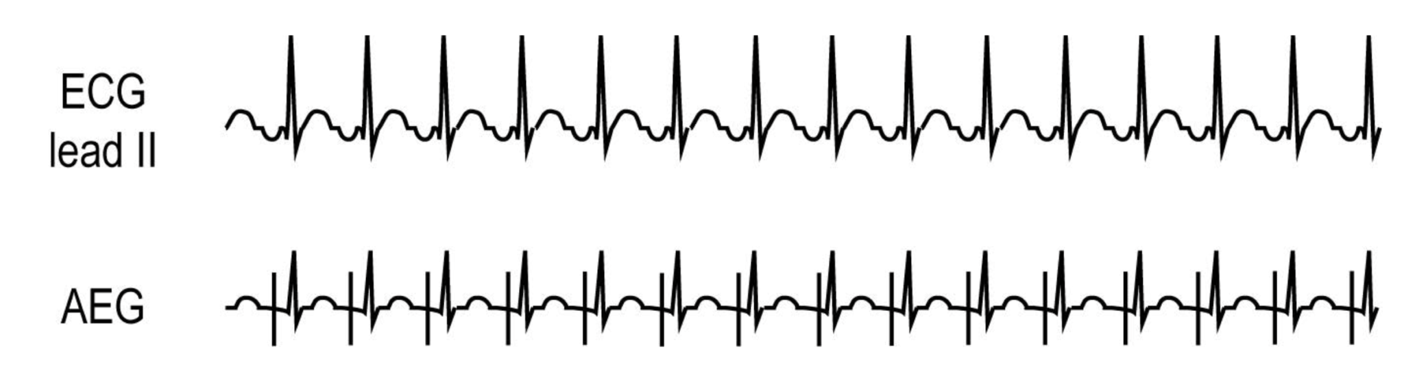 Atrial Ectopic Tachycardia (AET) – Atrial Electrogram Education – UW ...