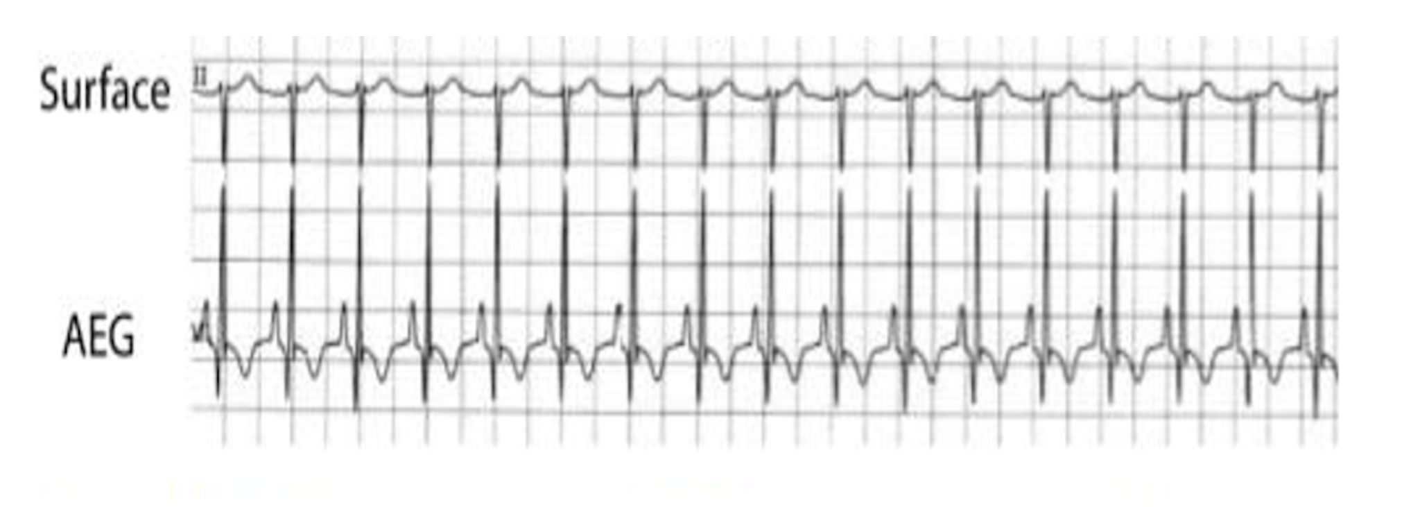 Atrial Ectopic Tachycardia (AET) – Atrial Electrogram Education – UW–Madison